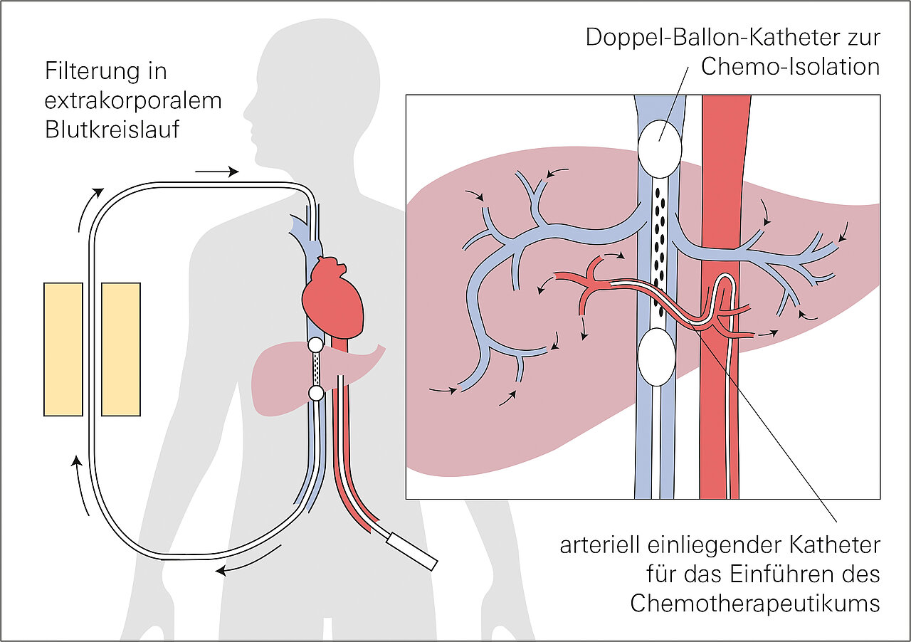 Neue Therapieoption bei Leberkrebs - Fakultät für Humanwissenschaften